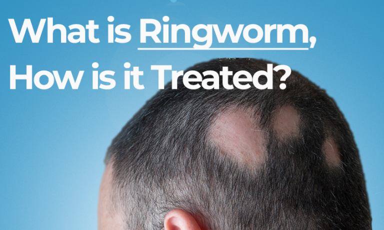 What is Ringworm, How is it Treated? - Quartz Hair