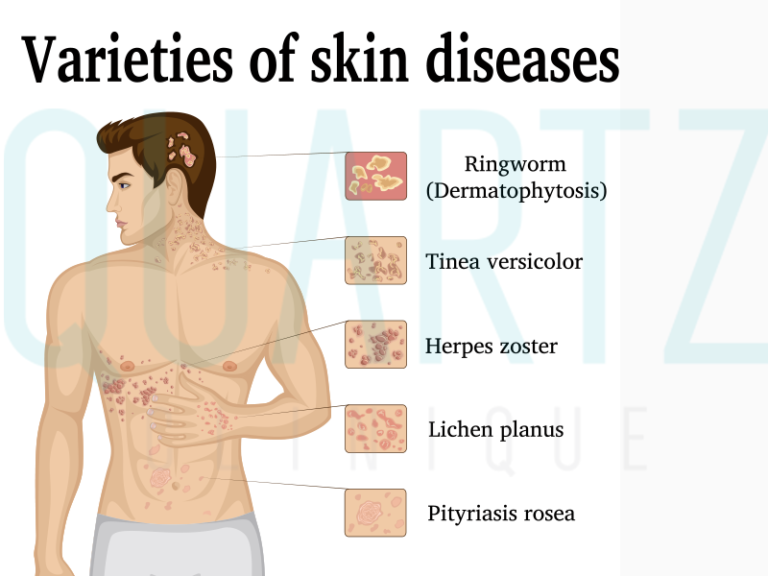 What is Ringworm, How is it Treated? - Quartz Hair