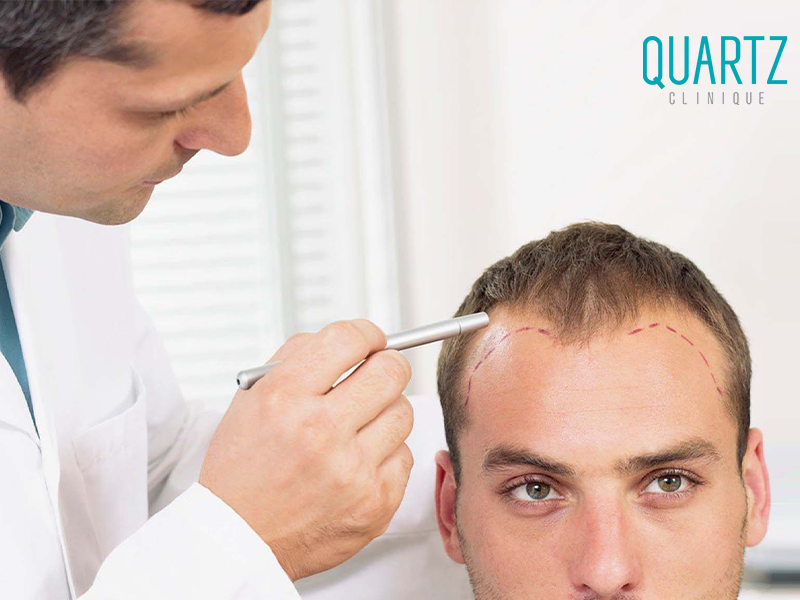 Turkey Hair Transplant 2024 Quartz Hair