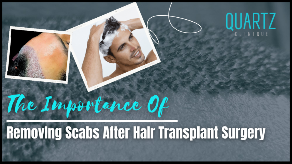 Removing Scabs After Hair Transplant Surgery – Quartz Hair