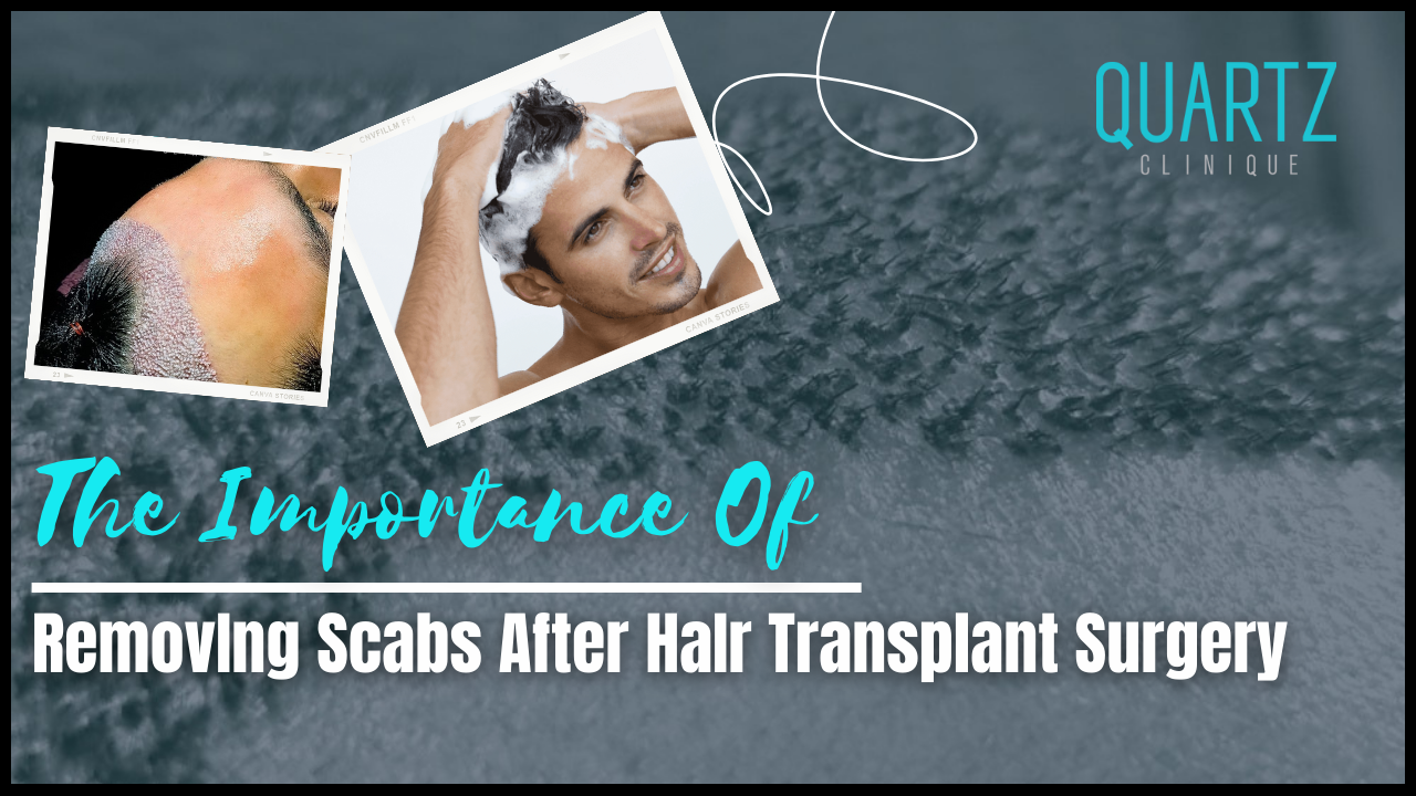 Removing Scabs After Hair Transplant Surgery – Quartz Hair